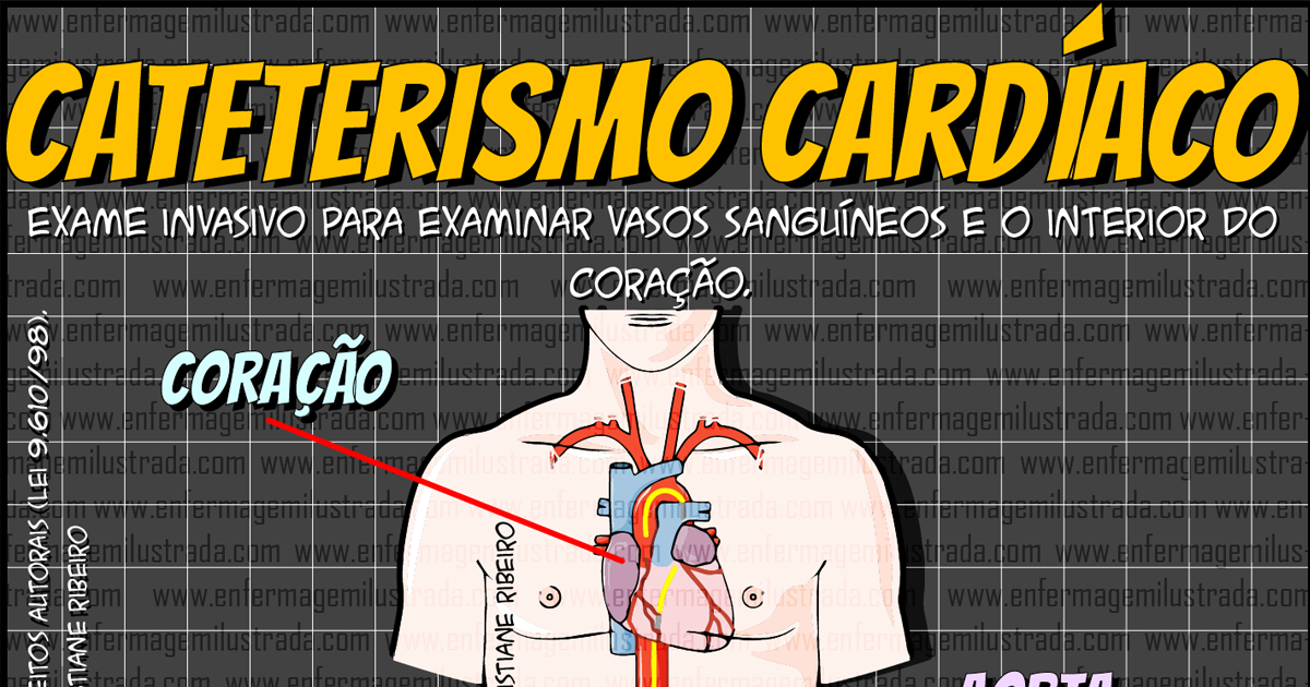 Cateterismo Cardíaco - Enfermagem Ilustrada