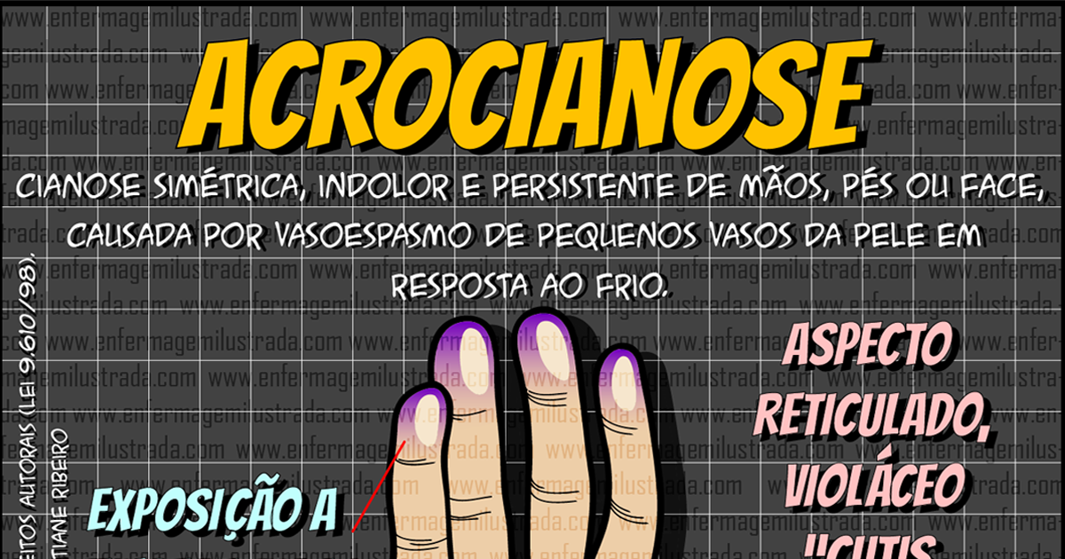 Acrocianose Vs Cianose Síndrome De Raynaud Distúrbios Do Coração