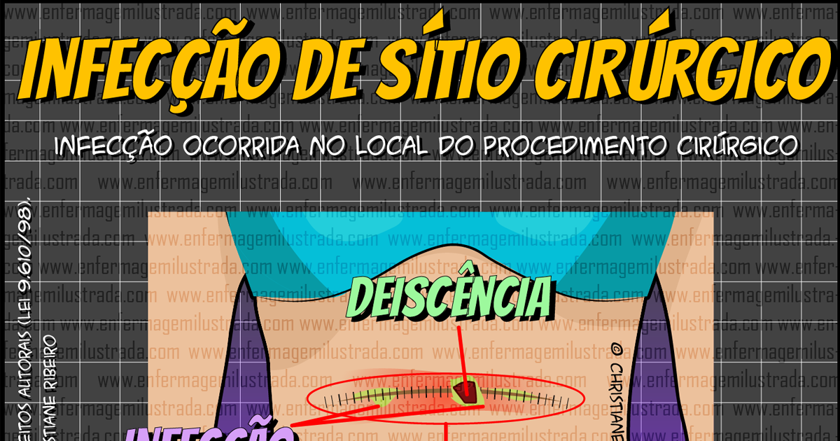 Cid Infecção Sitio Cirurgico - RETOEDU