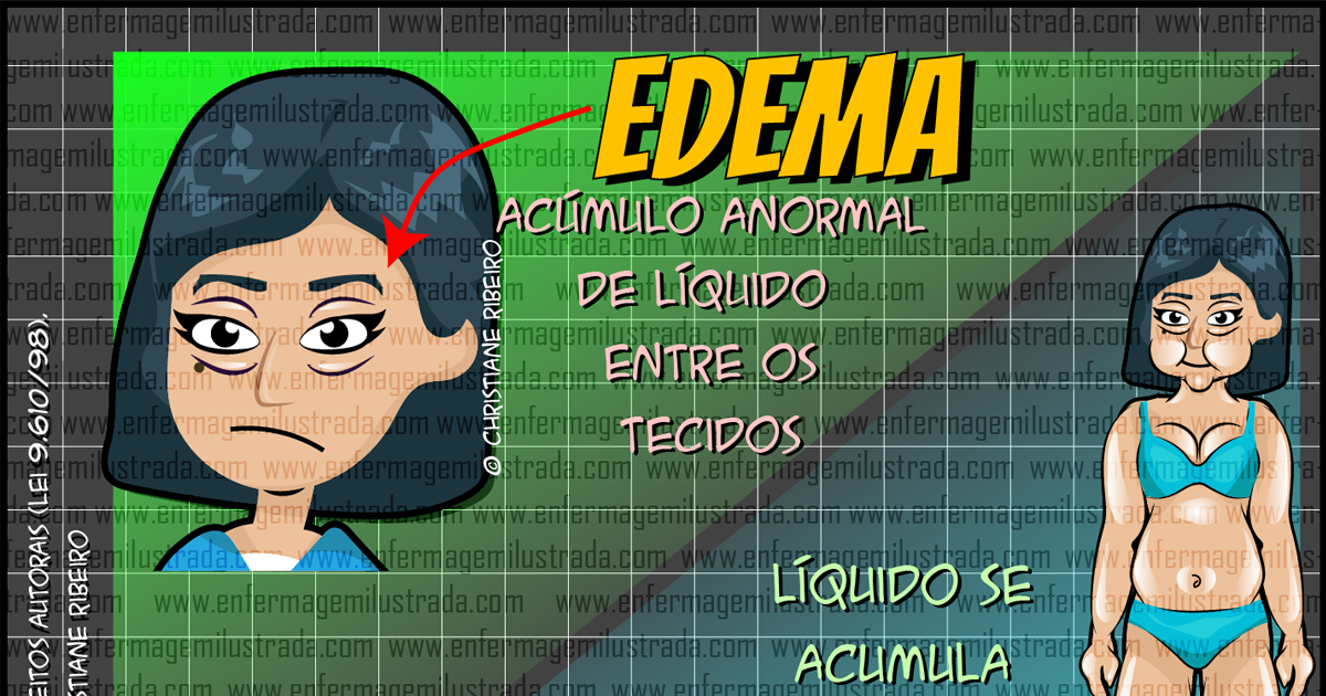 Edema e Anasarca: As diferenças - Enfermagem Ilustrada