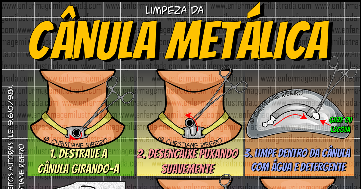 A limpeza da Cânula Metálica de Traqueostomia - Enfermagem Ilustrada