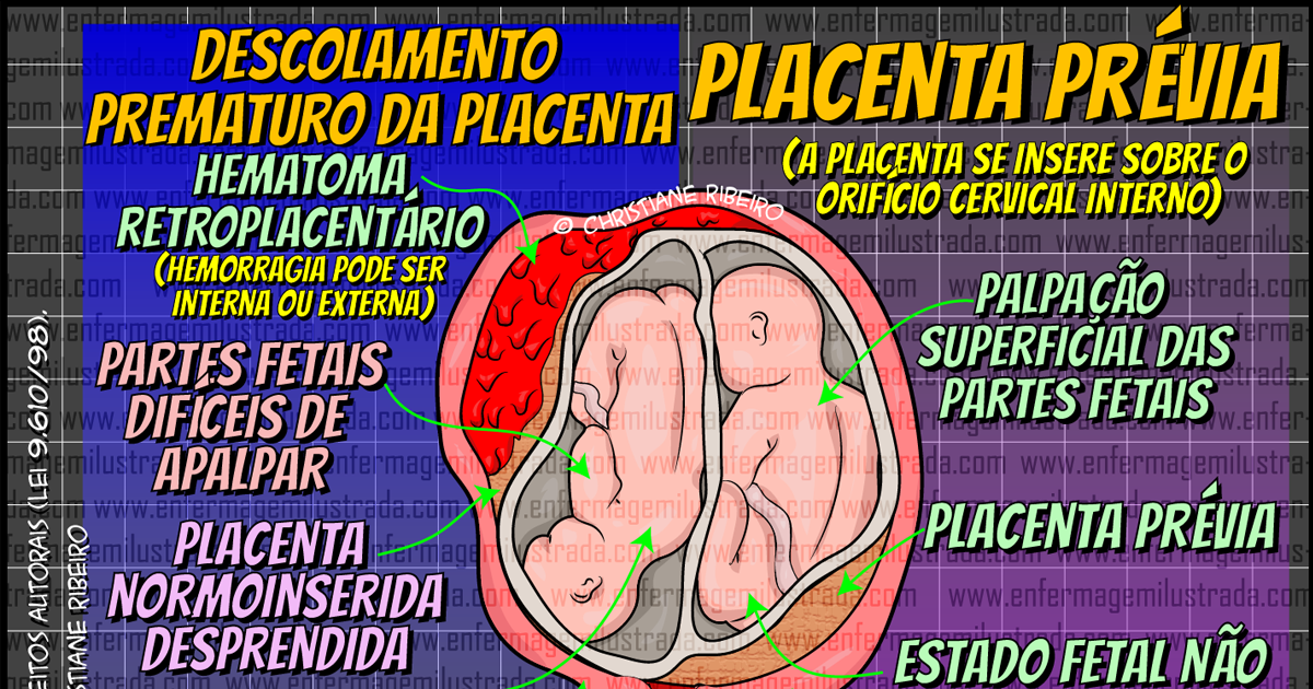 Descolamento Prematuro da Placenta (DPP) vs. Placenta Prévia - Enfermagem Ilustrada